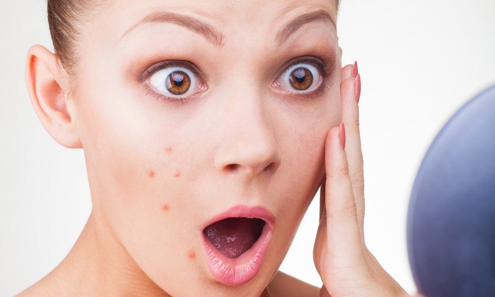 Tratamientos para acabar con las espinillas | mujerhoy.com